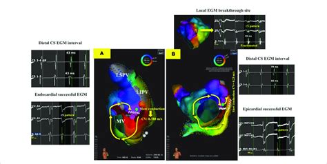 3 D Activation Map During Perimitral Afl In Endocardial And Epicardial Download Scientific