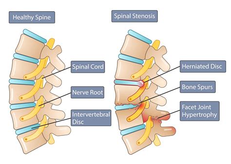 neural foraminal stenosis