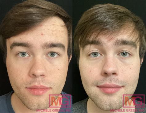 Accutane Before And After Mild Acne Banda Right Before Going On