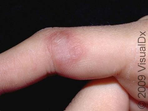 Herpes On Finger Cure