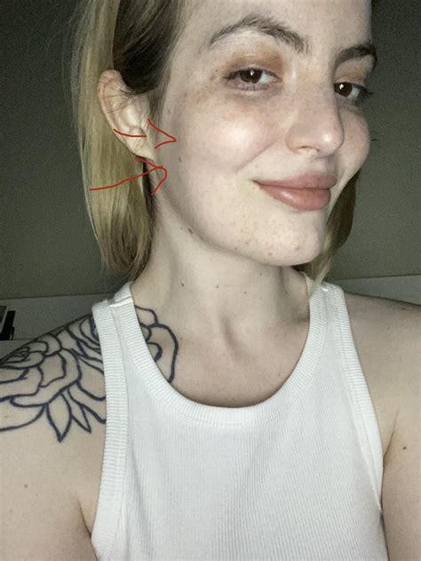 Overfilled Cheeks R Plasticsurgery