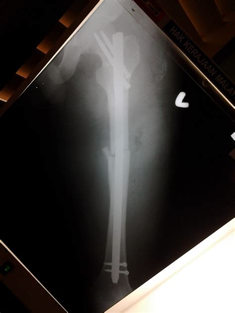 Dr Syukran Closed Proximal 3rd Left Femur Fracture