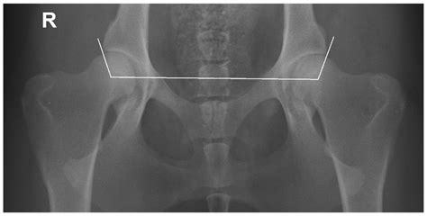Acetabular Coverage Area Occupied By The Femoral Head As An Indicator