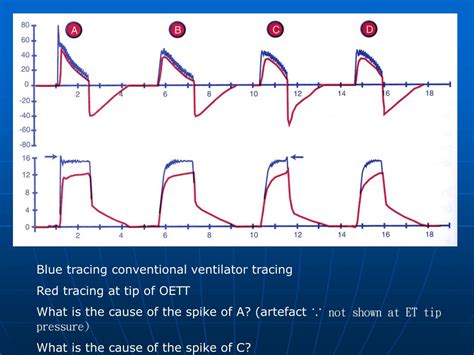 Ppt Ventilator Waveform Analysis Often Ignored Bedside Assessment Powerpoint Presentation