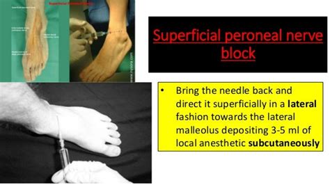 Peripheral Nerve Block Ankle Block Wrist Block Digital Block