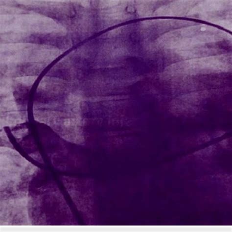 Catheter Course Of Supracardiac Total Anomalous Pulmonary Communication