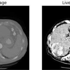 A CT Scan Image Of Diffuse Hepatic Steatosis Known As Fatty Liver Download Scientific Diagram