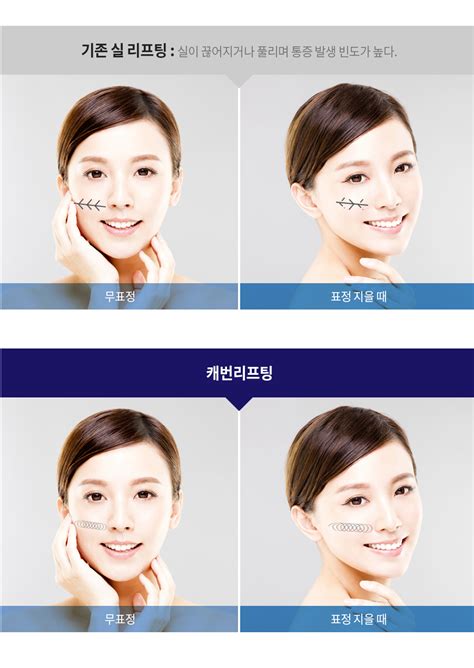 김석주 피부과 캐번리프팅