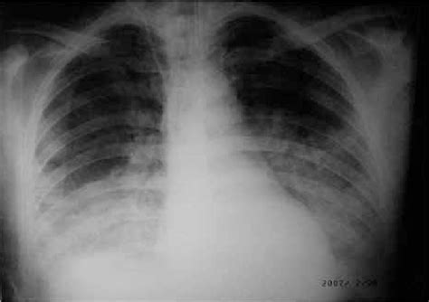 Bilateral Fluffy Infiltration On Chest X Ray Performed When Patient