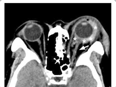 Axial Ct Acquisition Reconstructed With Soft Tissue Algorithm In An