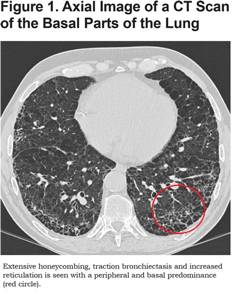 Emphysema Lung Vs Normal Lung