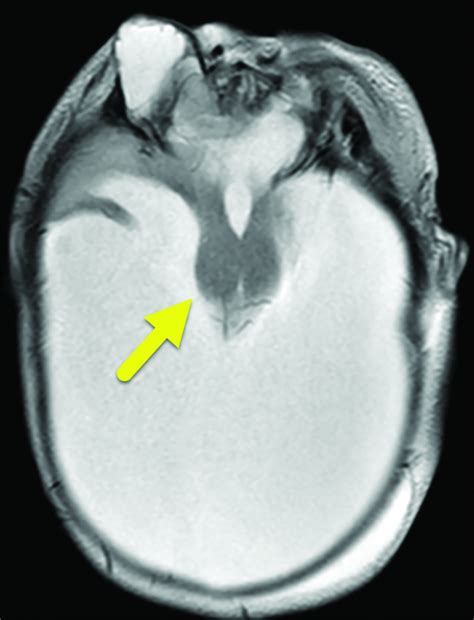 Alobar Holoprosencephaly Applied Radiology