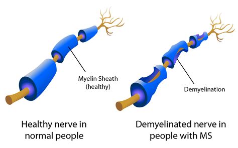 What Is Multiple Sclerosis Fight Ms With Hkmss