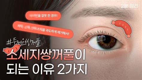 [2분 정리] 소세지쌍꺼풀이 되는 이유 2가지 Youtube