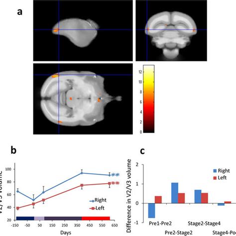 Gray Matter Increases In Bilateral Lateral Extrastriate Cortex