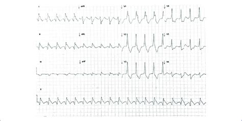 Ecg Shows Wide Complex Monomorphic Tachycardia With The Left