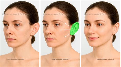 Otoplasty Reshape Your Ears Safely With Or Without Surgery