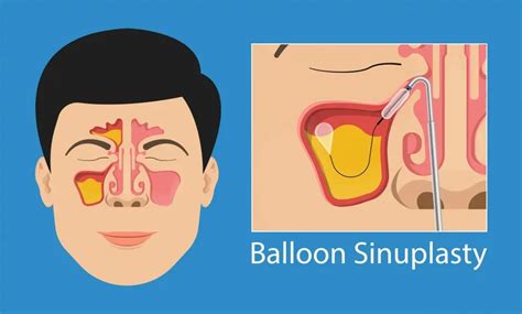 Balloon Sinuplasty What To Expect During The Procedure Board