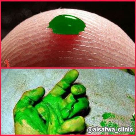 Sulfhemoglobinemia Medizzy