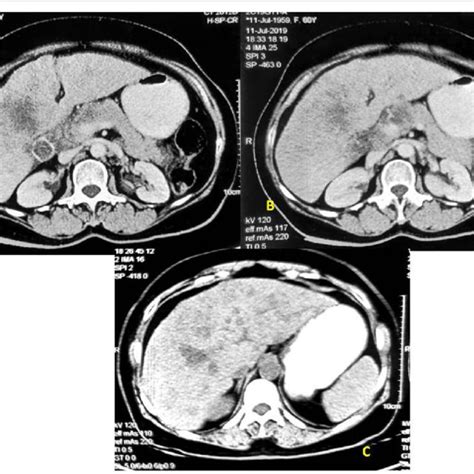 Pretreatment Ct Scan Showing A Mass In The Fundus Of Gallbladder Download Scientific Diagram