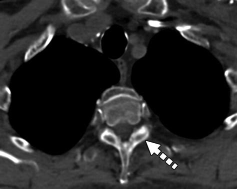 Virtual Noncontrast Reconstructions On Contrast Enhanced Dual Energy Ct For The Differentiation