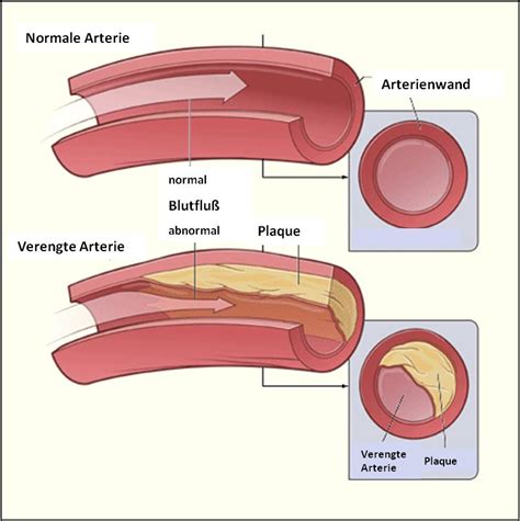 Atherosklerose Eine Autoimmunerkrankung Auslöser Und Gegenstrategien Scienceblog