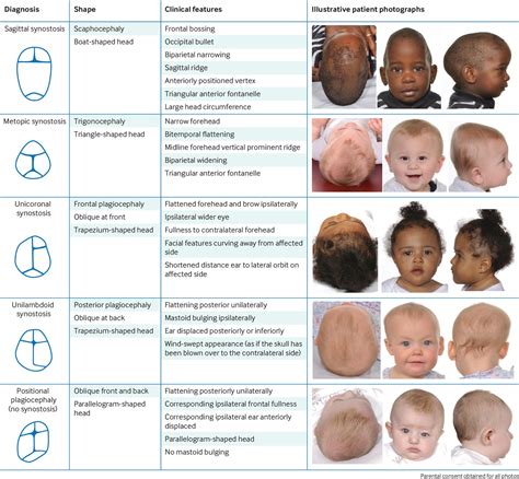 Facts About Craniosynostosis Cdc 43 Off