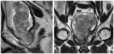 Intravesical Protrusion Of Giant Median Prostatic Lobe A Case Report