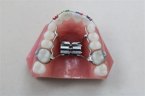 Palate Expander Malaysia At Bernice Parker Blog