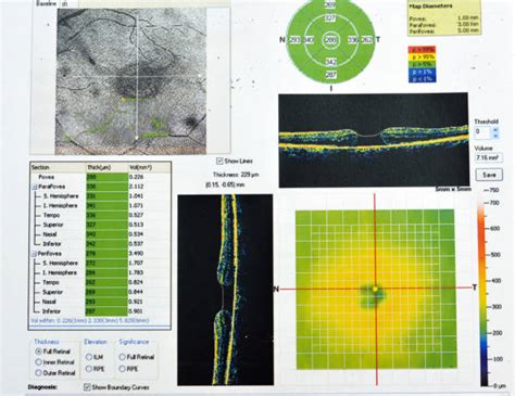 160 Exudate Foto Foto Stok Potret And Gambar Bebas Royalti Istock