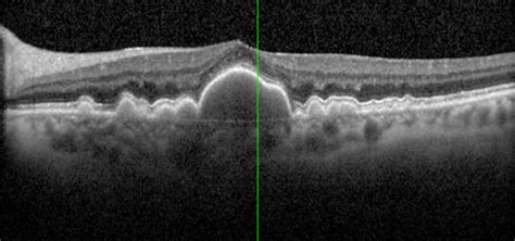 Oct Interpretation In Amd Csr And Choroidal Conditions Gloucestershire Research And Education