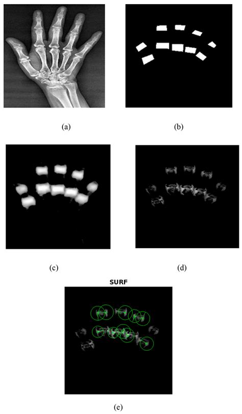 Ra Xtnet A Novel Cnn Model To Predict Rheumatoid Arthritis From Hand