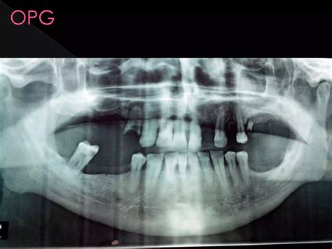 Case Ppt Mental Nerve Neuralgia Pptx Brain And Nervous System Disorders Diseases And