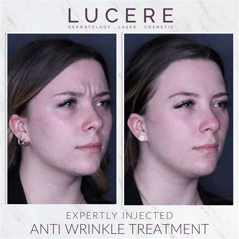 Botox Before And After Under Eyes