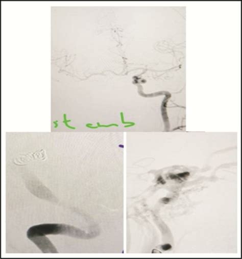 Trans Arterial Coil Embolization Download Scientific Diagram