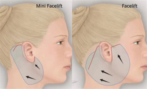 Mini Facelift Procedure Risks Effectiveness And More