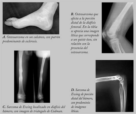 I Ewing Sarcoma Eyona Nkqubela Phambili Yamva Nje Kulwazi Lwesi Sifo