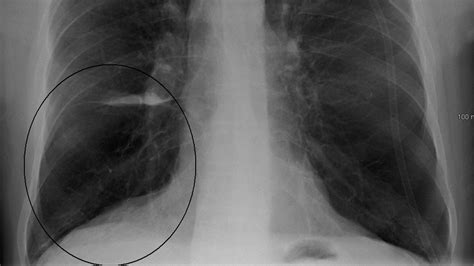 Copd X Ray Asthma Lung Disease