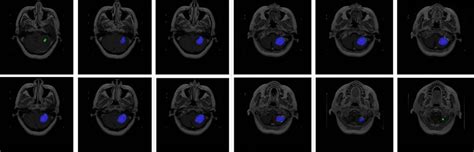 Visualization The Segmentation By The Ensemble Strategy Download