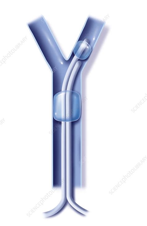 Bronchial Blocker Stock Image C021 4666 Science Photo Library