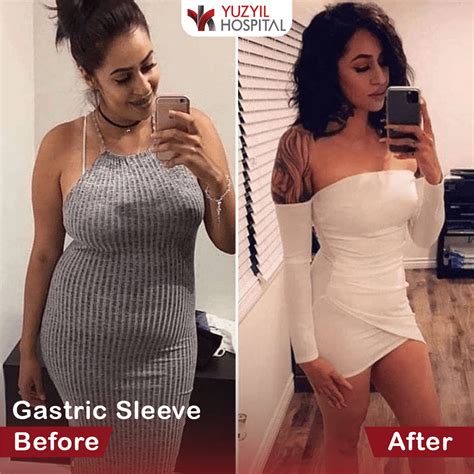 Gastric Sleeve