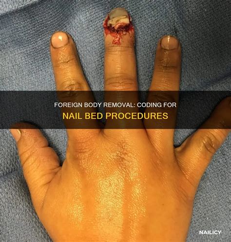 Foreign Body Removal Coding For Nail Bed Procedures Nailicy