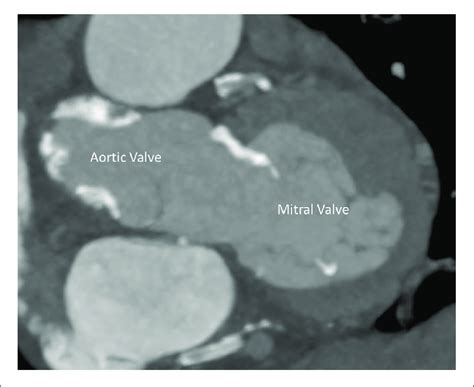 Mitral Valve Calcification Download Scientific Diagram