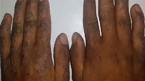 Atopic Dermatitis Vs Contact Dermatitis Whats The Difference