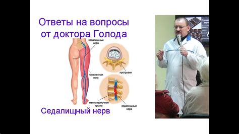 Как лечить седалищный нерв ответ от доктора Голода Youtube