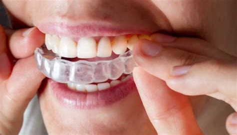 Byte Invisible Aligners Cost