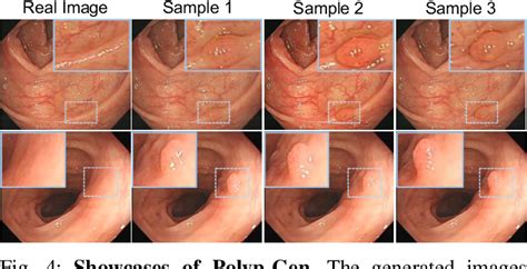 Polyp Gen Realistic And Diverse Polyp Image Generation For Endoscopic Dataset Expansion