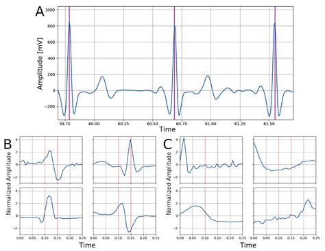 Improving The Efficacy Of Deep Learning Models For Heart Beat Detection On Heterogeneous Datasets