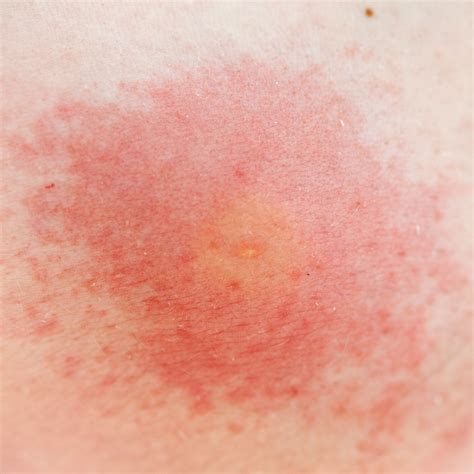Identifying Insect Bites 17 Pictures Of Common Bug Bites