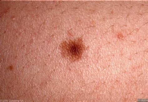 Unveiling The Mystery Of Dermal Melanocytic Nevi A Comprehensive Guide Justinboey